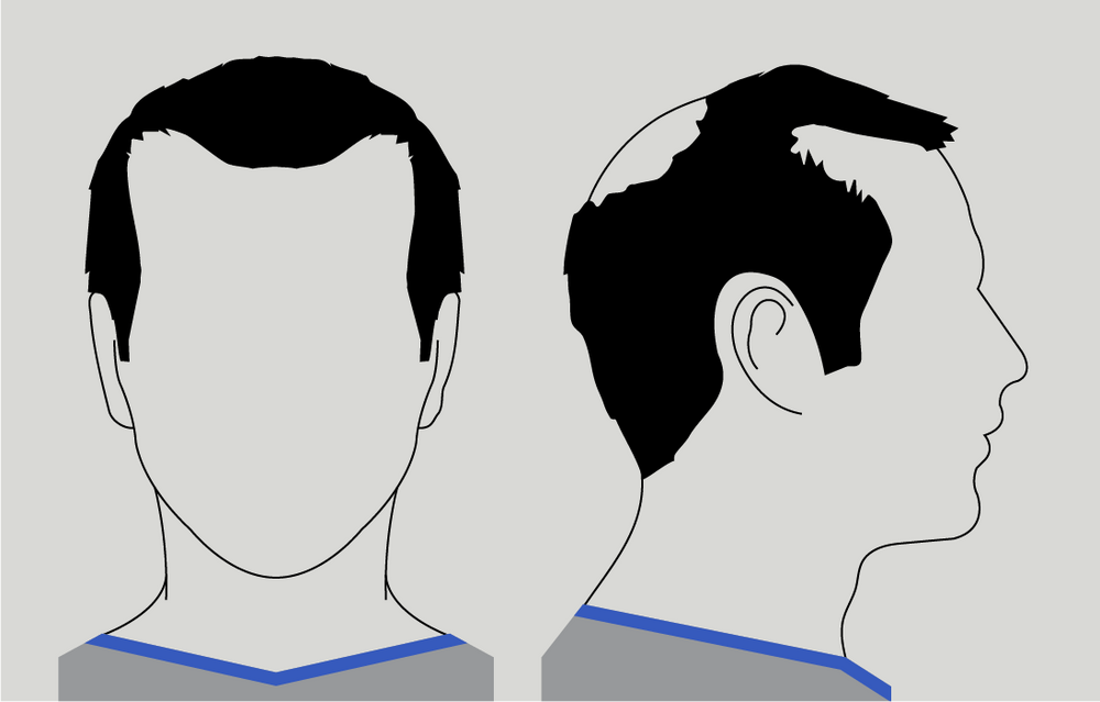 Hair Loss Treatments for Men | XYON Treatments & Products