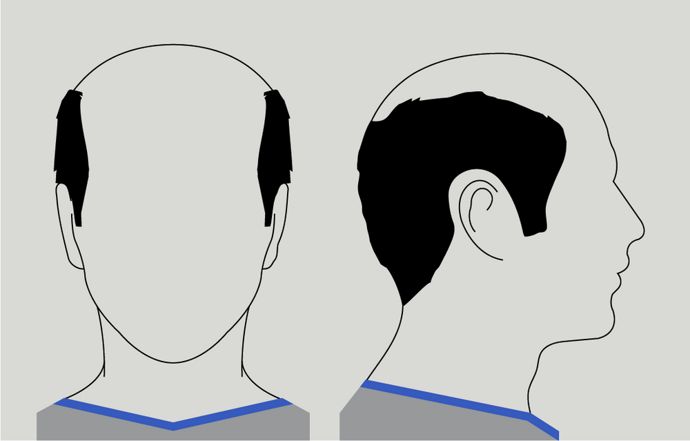 Hair Loss Treatments for Men | XYON Treatments & Products